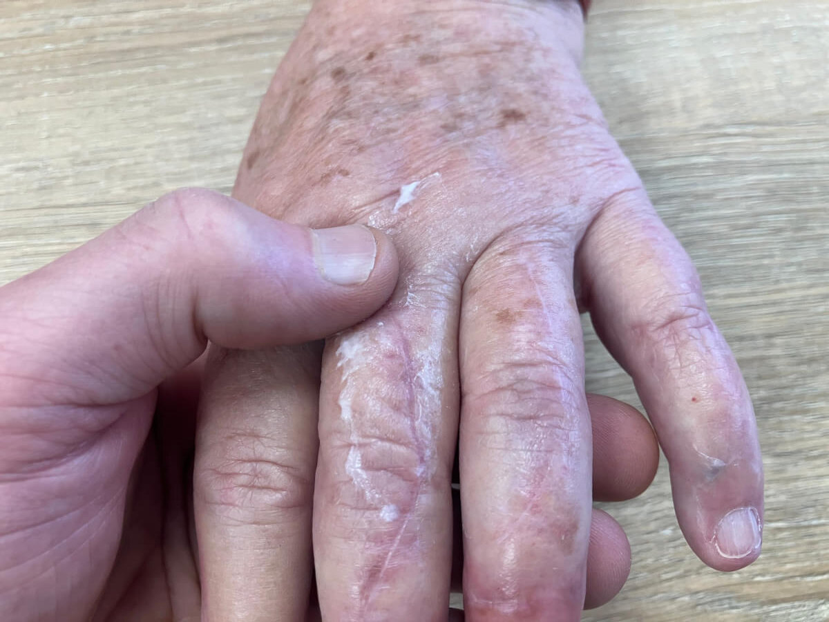 What to do for a Drooping Fingertip / Mallet Finger? - SA Hand Therapy